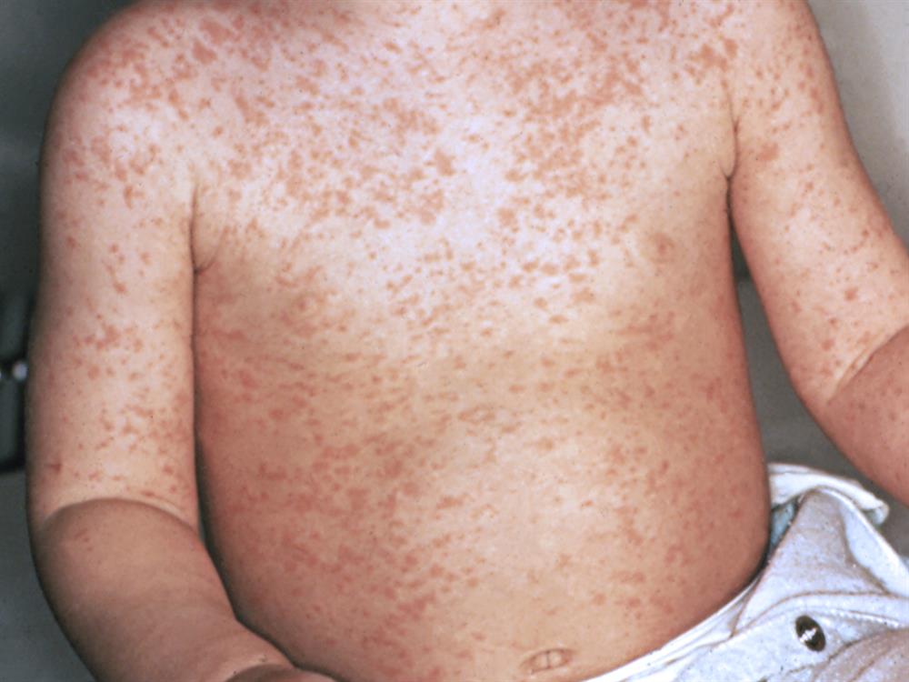 Cosas que debes saber sobre el sarampión - Noticias Uruguay, LARED21 ...