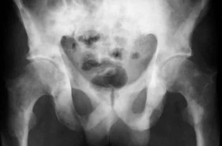 11 de junio: Día mundial de la Prevención del Cáncer de Próstata ...